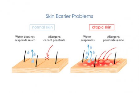Atopic dermatitis: explanations and advice from our experts | BIODERMA